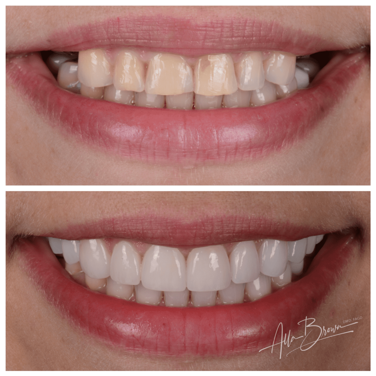 Dental Crown Smile Gallery for Buford GA Dentist