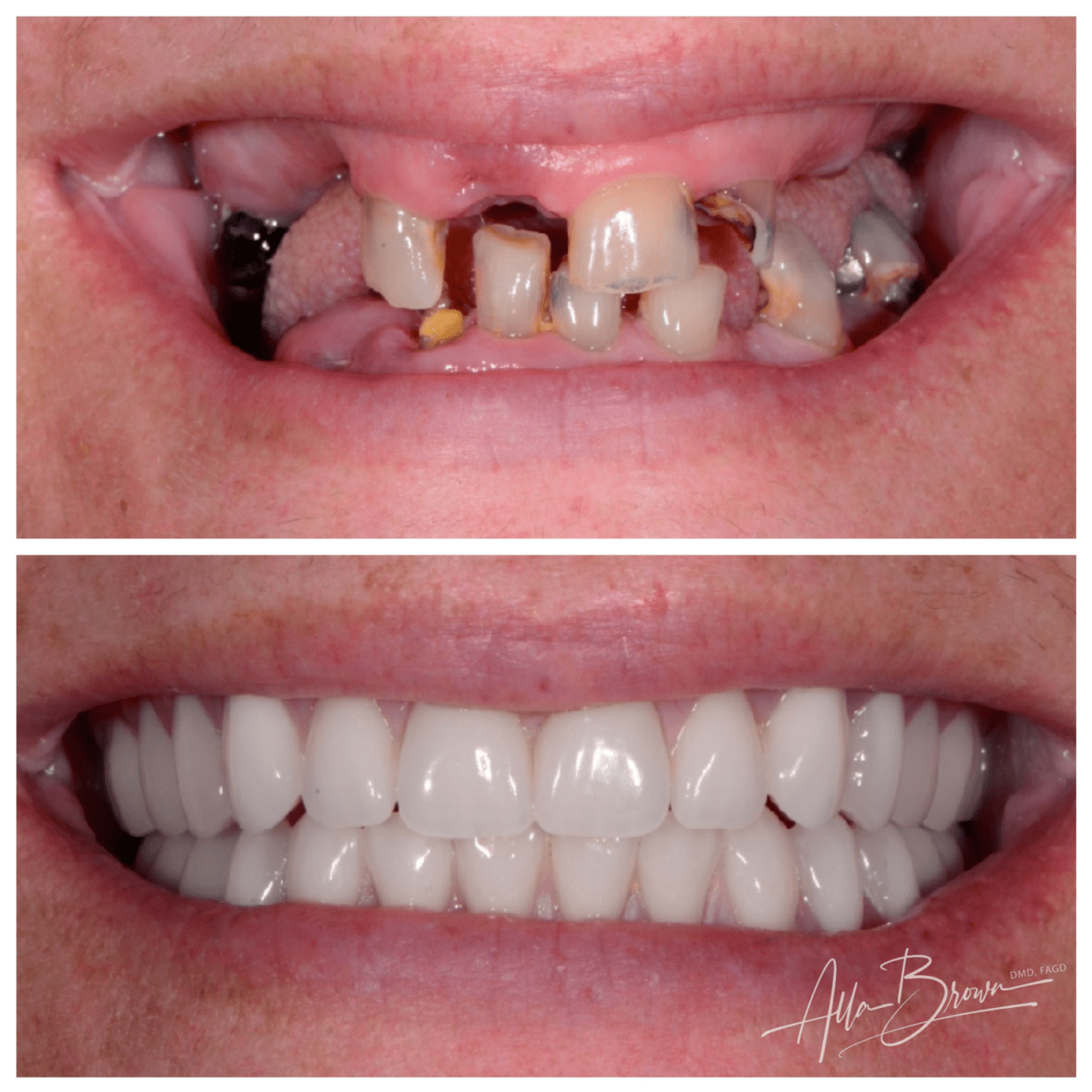 Cosmetic Dentures Smile Gallery for Buford GA Dentist